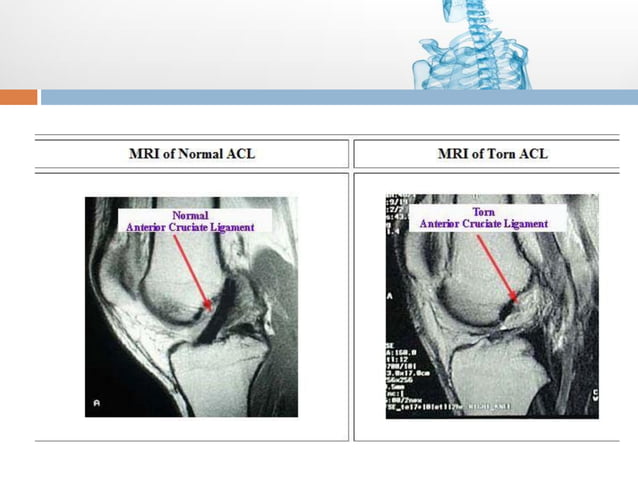 ACL tear