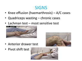 Acl tear | PPTX
