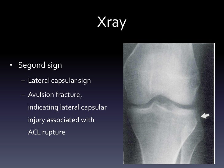 ACL Reconstruction - Update 2012