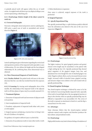 Impactions in Orthodontics – A Review | PDF