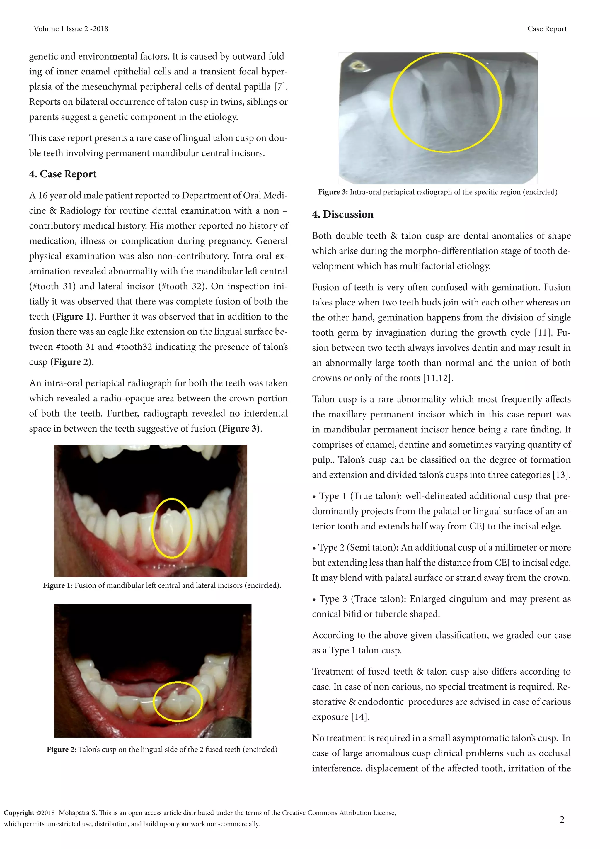 Co-Existence of Synodontia & Talon Cusp in Mandible: A Rare Case | PDF