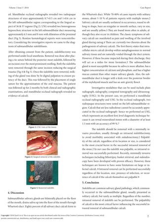 Multiple Submandibular Duct Calculi: A Case Report | PDF