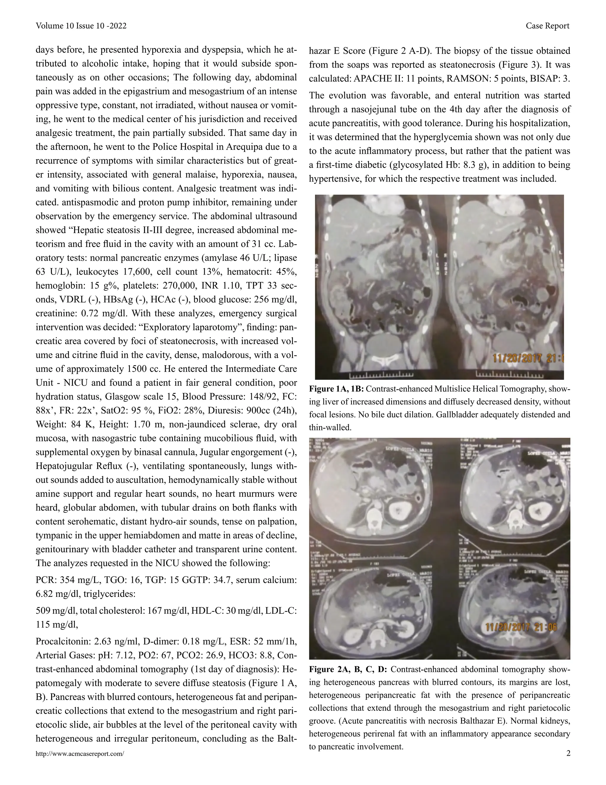 Severe Acute Pancreatitis with Normal Amylase and Lipase Levels, A Case ...