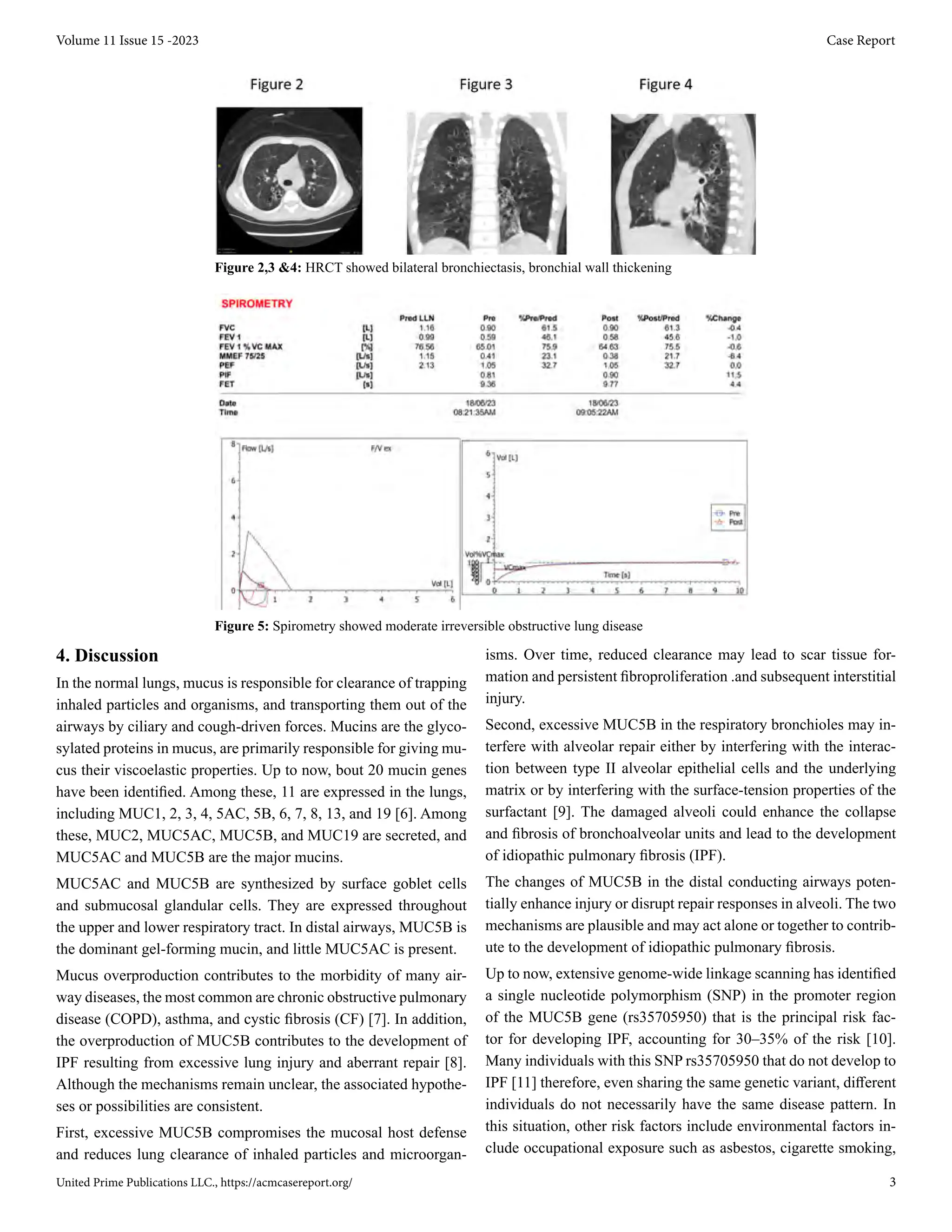 MUC5B Mutation Causes Mucociliary Dysfunction and Primary Ciliary ...