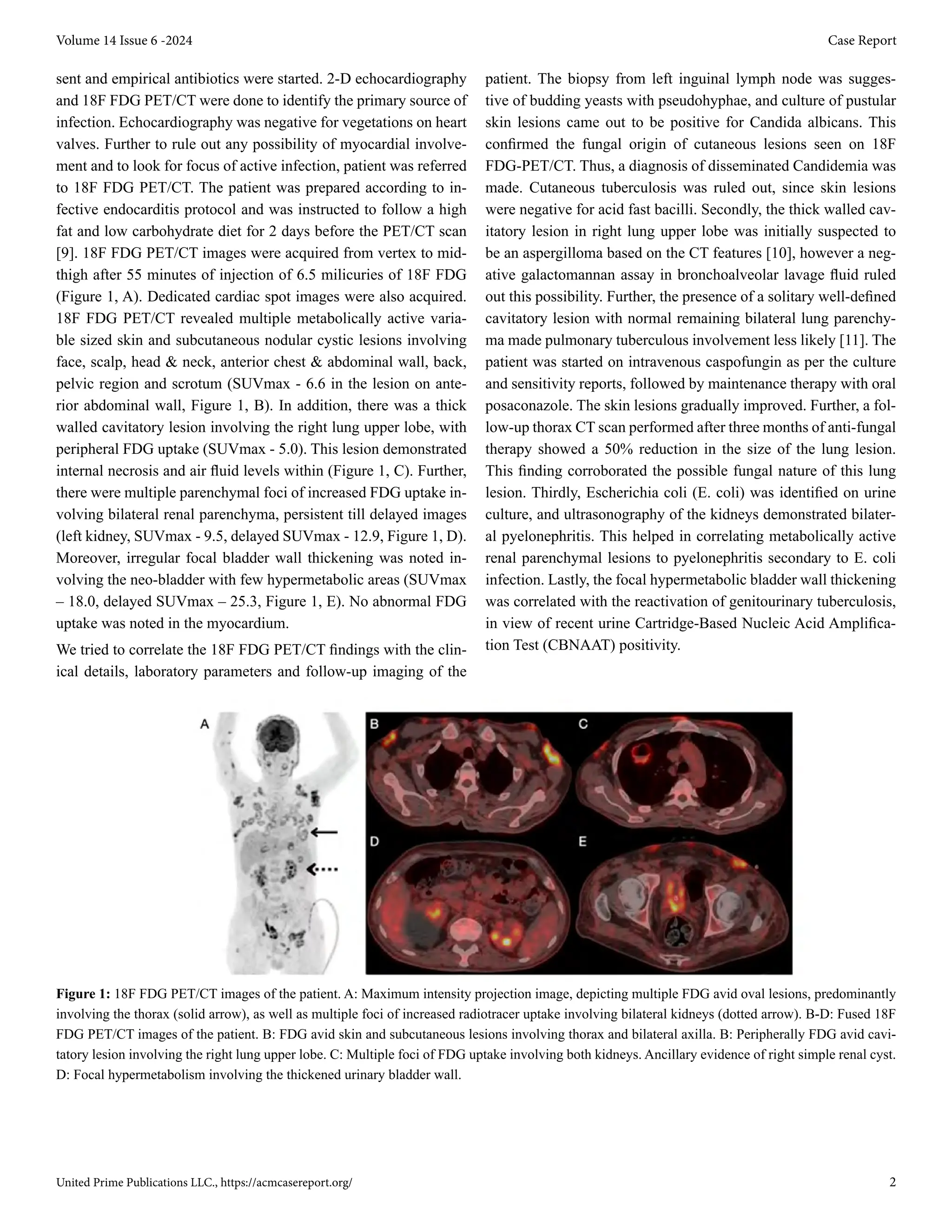 Disseminated Infection Characterization on FDG-PET/CT: Clinico-LaboratoryRadiological ...