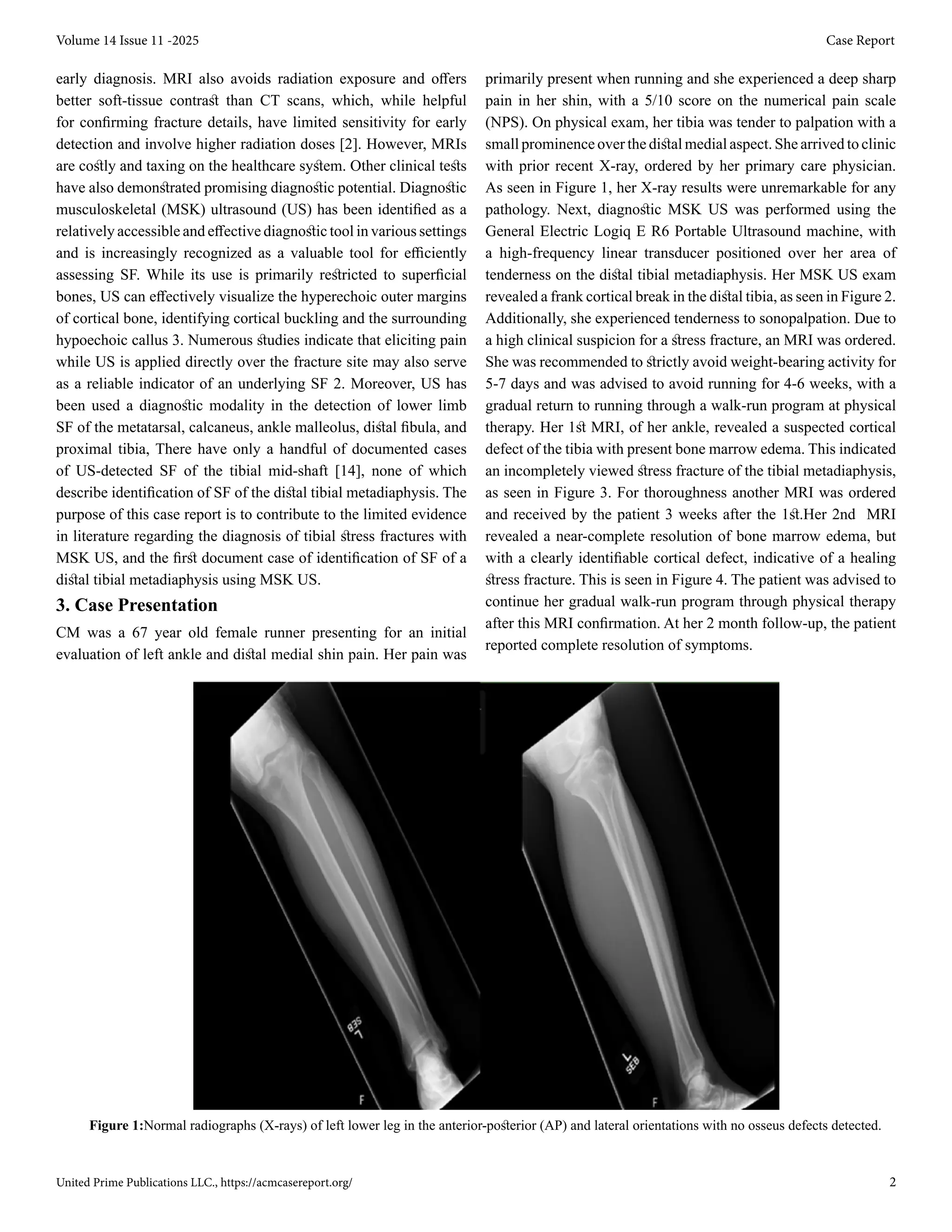 Using Musculoskeletal Ultrasound to Identify A Tibial Metadiaphysis ...