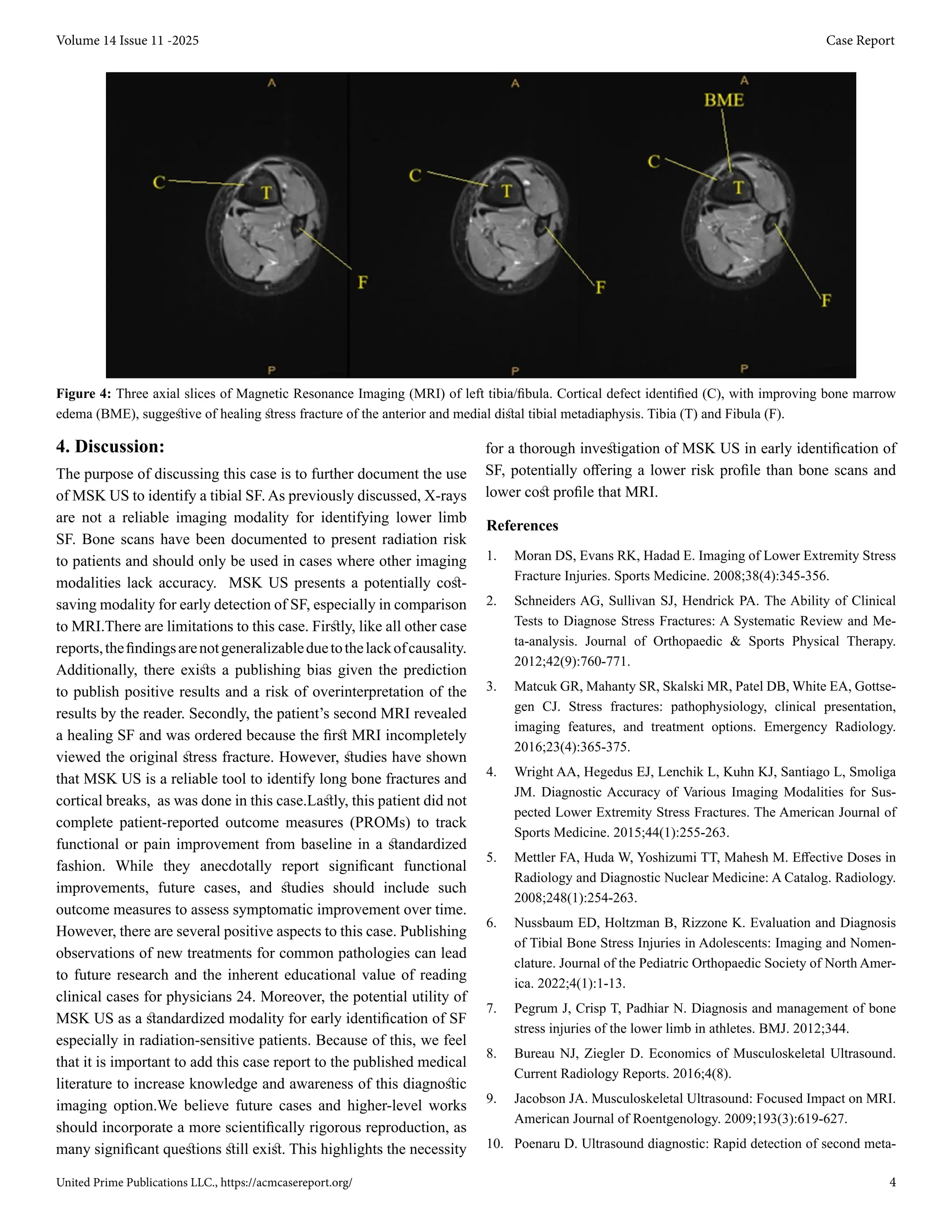 Using Musculoskeletal Ultrasound to Identify A Tibial Metadiaphysis ...