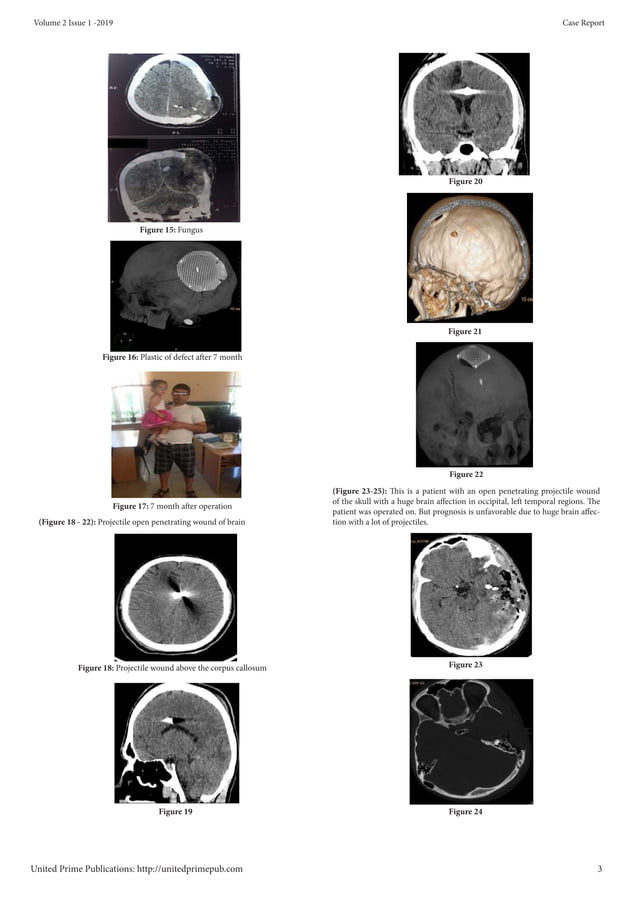 Modern Military Neurotrauma and its Complications in War Conditions in ...