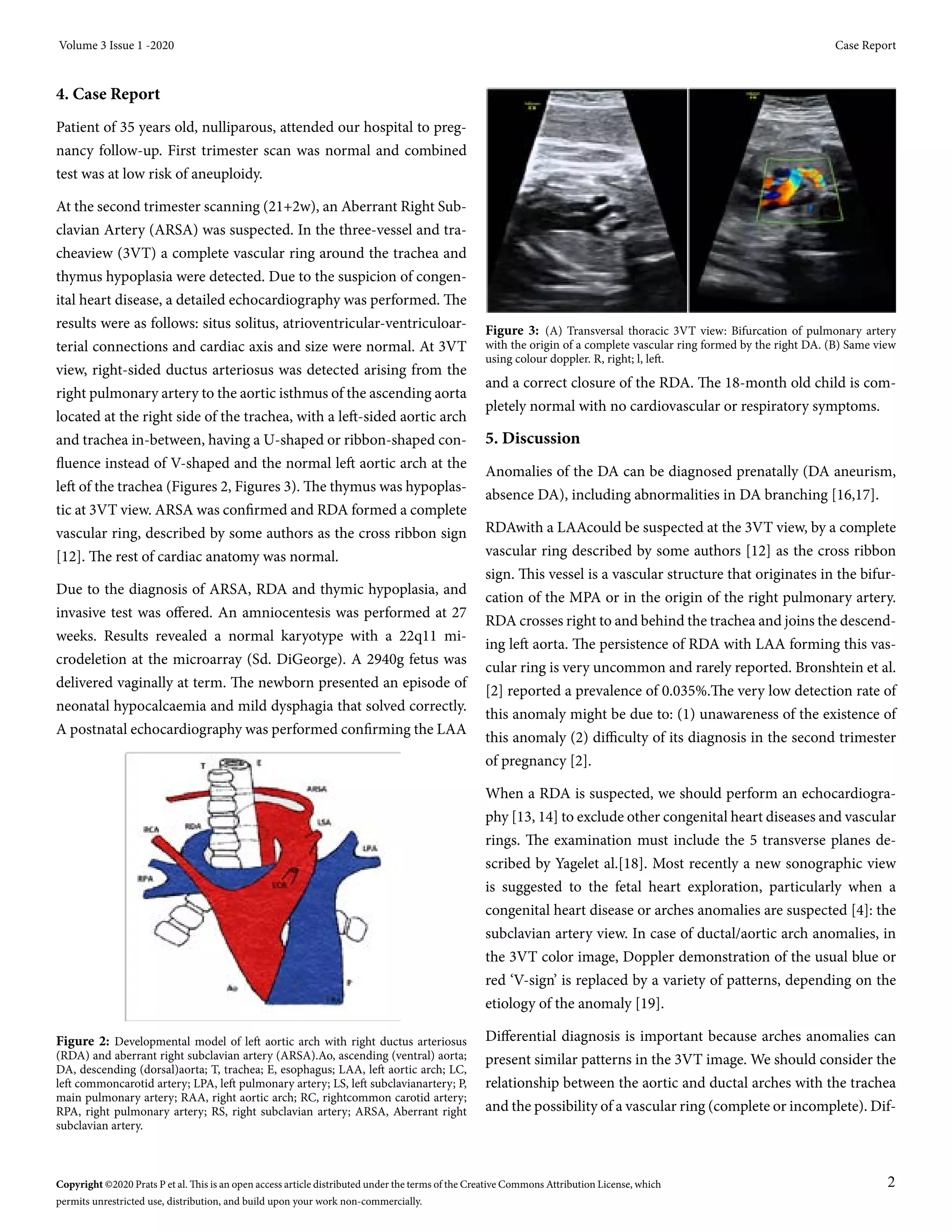 Fetal Vascular Rings: Beyond The Anomalies of The Aortic Arch | PDF