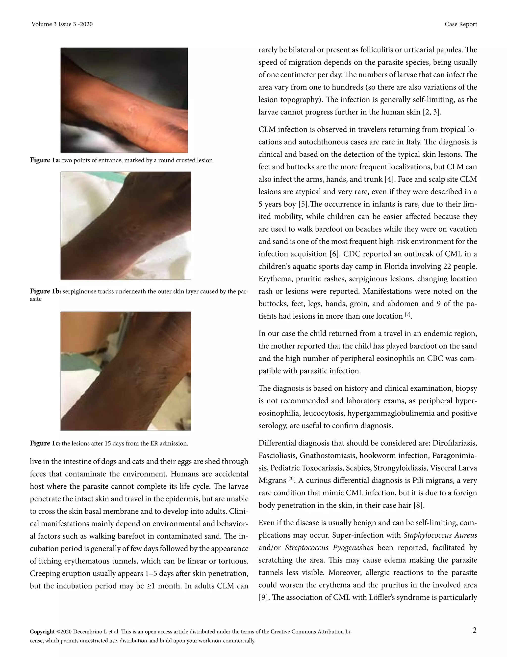 Cutaneous Larva Migrans: A Case Report in a Traveler Child | PDF