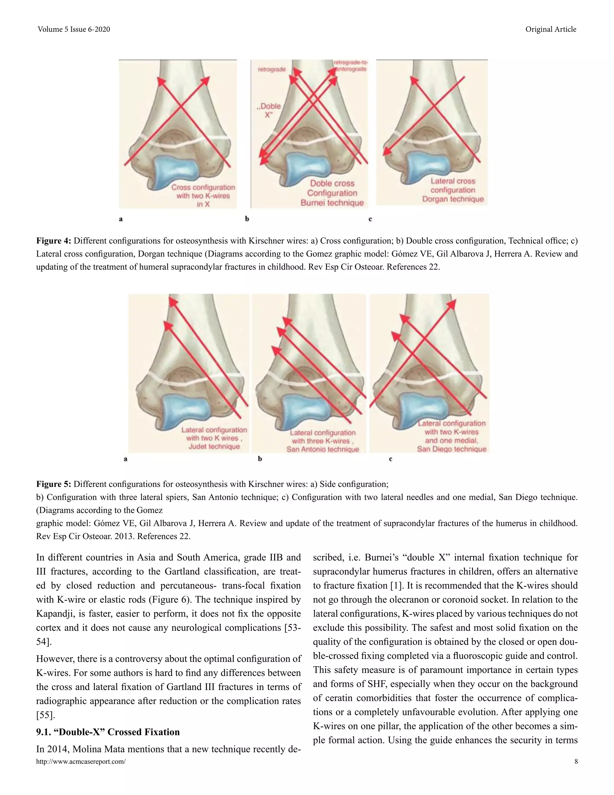 ‘Double X’ Cross Fixationin Paediatric Supracondylar Humerus Fractures ...
