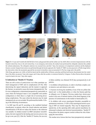 ‘Double X’ Cross Fixationin Paediatric Supracondylar Humerus Fractures ...