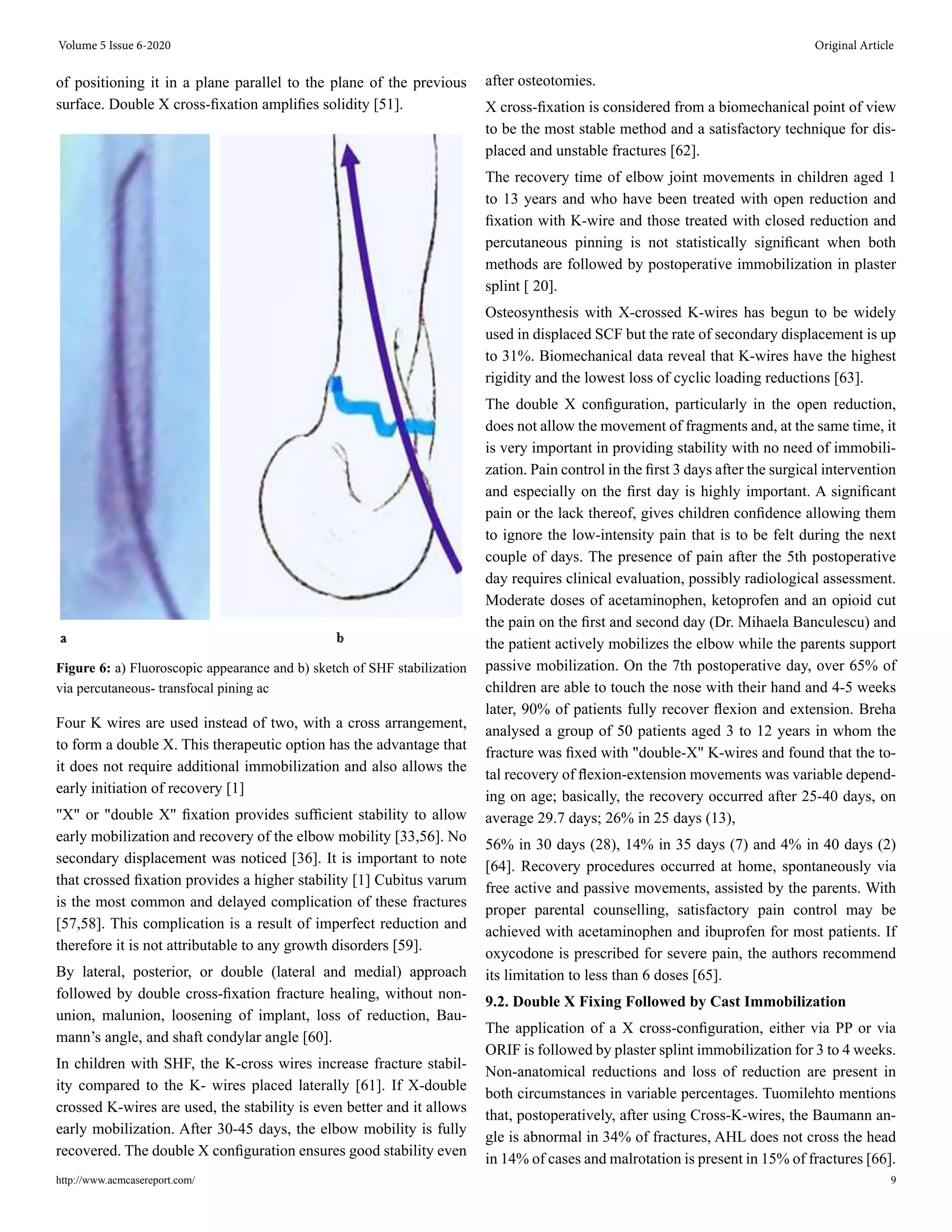 ‘Double X’ Cross Fixationin Paediatric Supracondylar Humerus Fractures ...