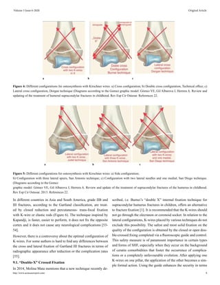 ‘Double X’ Cross Fixationin Paediatric Supracondylar Humerus Fractures ...