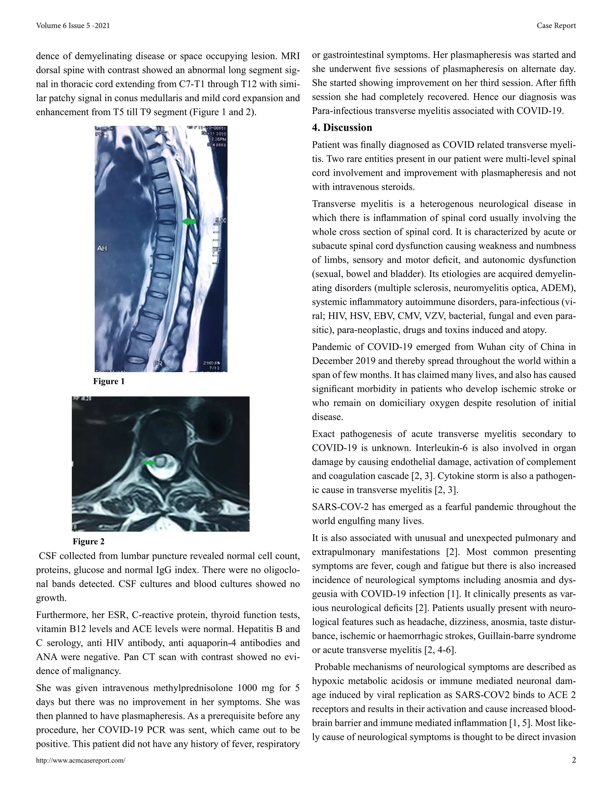 Transverse Myelitis in a Patient with COVID-19: A Case Report | PDF