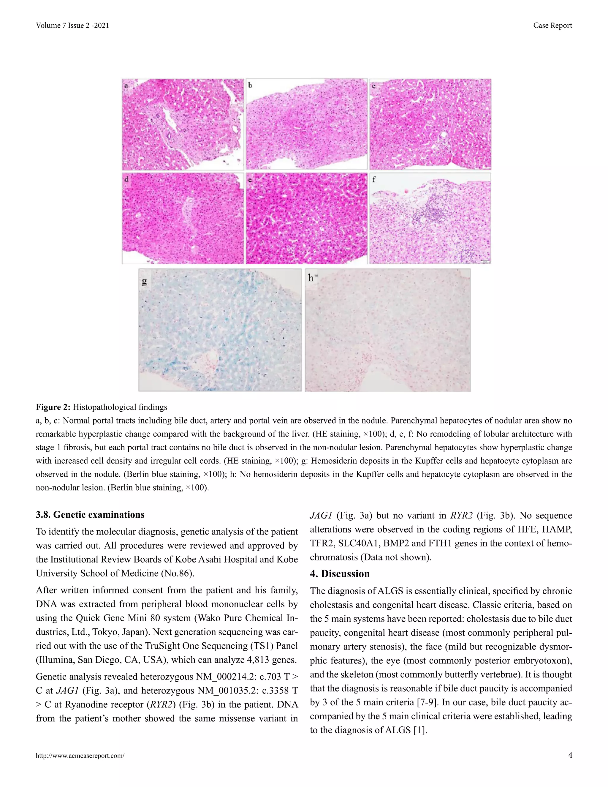 Iron deposit central large nodule in Alagille syndrome | PDF