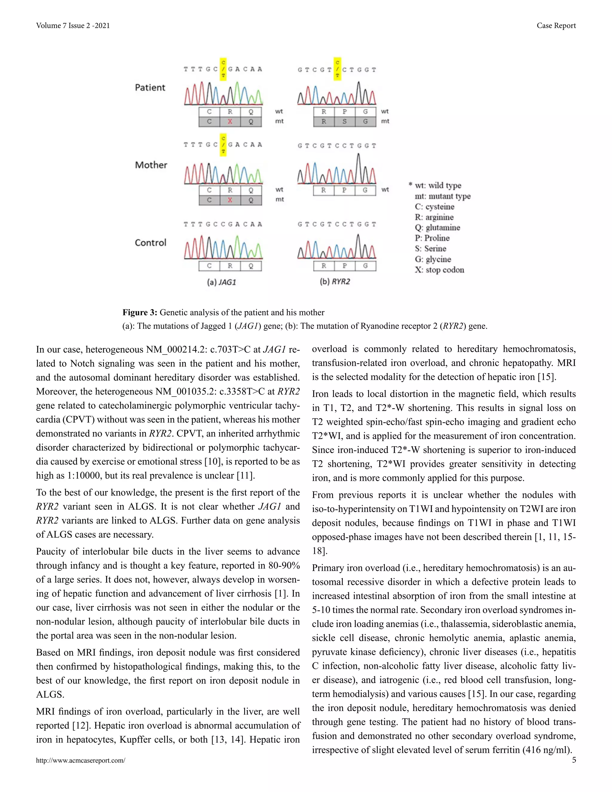 Iron deposit central large nodule in Alagille syndrome | PDF