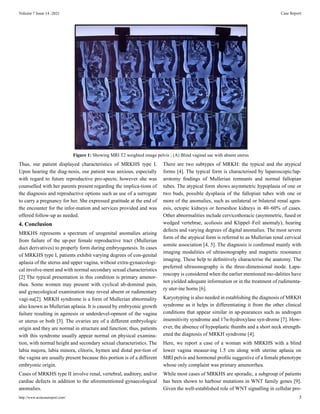 Mayer- Rokitansky- Kuster- Hauser Syndrome (MRKH SYNDROME)- An Unusual ...