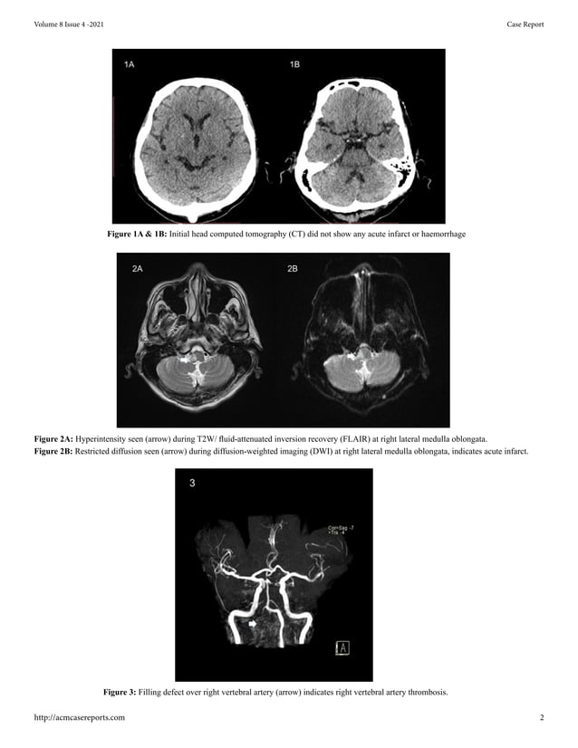 Laparoscopic Resection of Large Endo-Cervical Polyp Through Posterior…