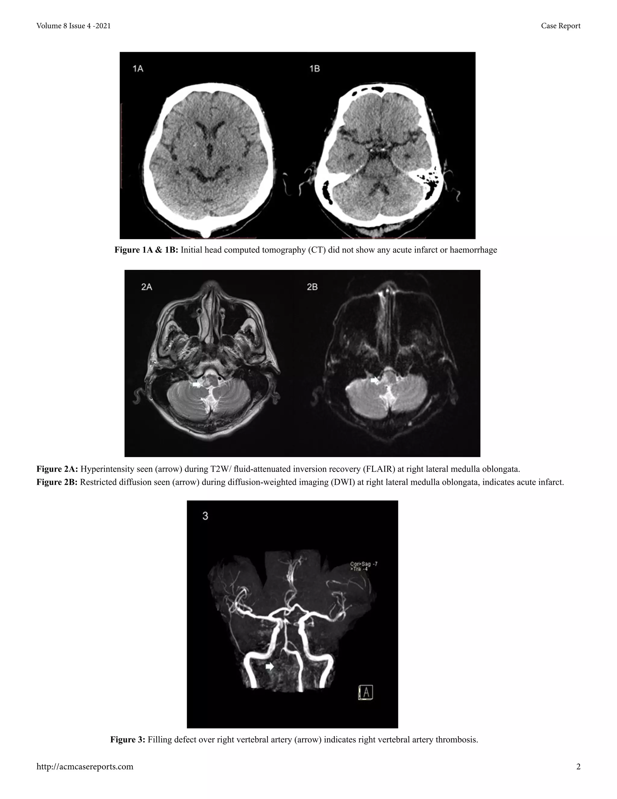 Atypical Lateral Medullary Syndrome | PDF