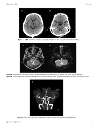 Atypical Lateral Medullary Syndrome | PDF