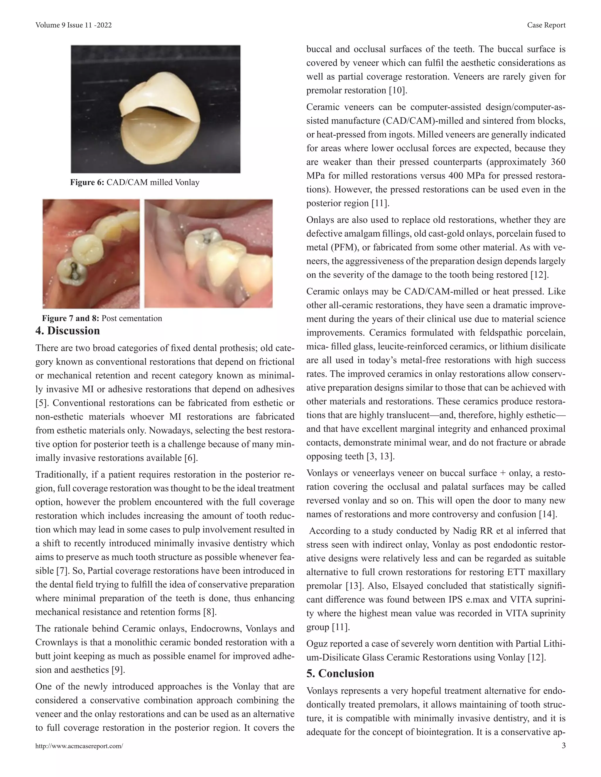 Vonlay; A paradigm shift in post endodontic restoration: A case report ...