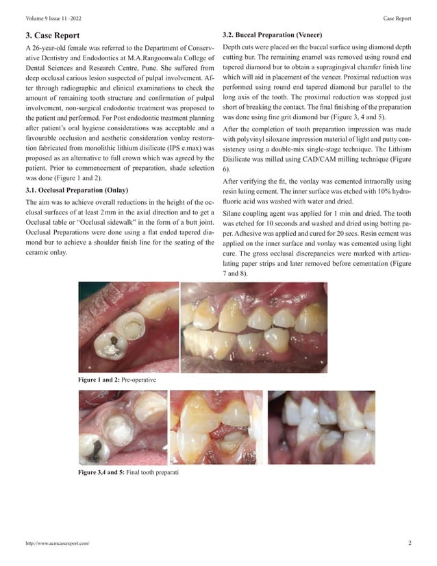 Vonlay; A paradigm shift in post endodontic restoration: A case report ...