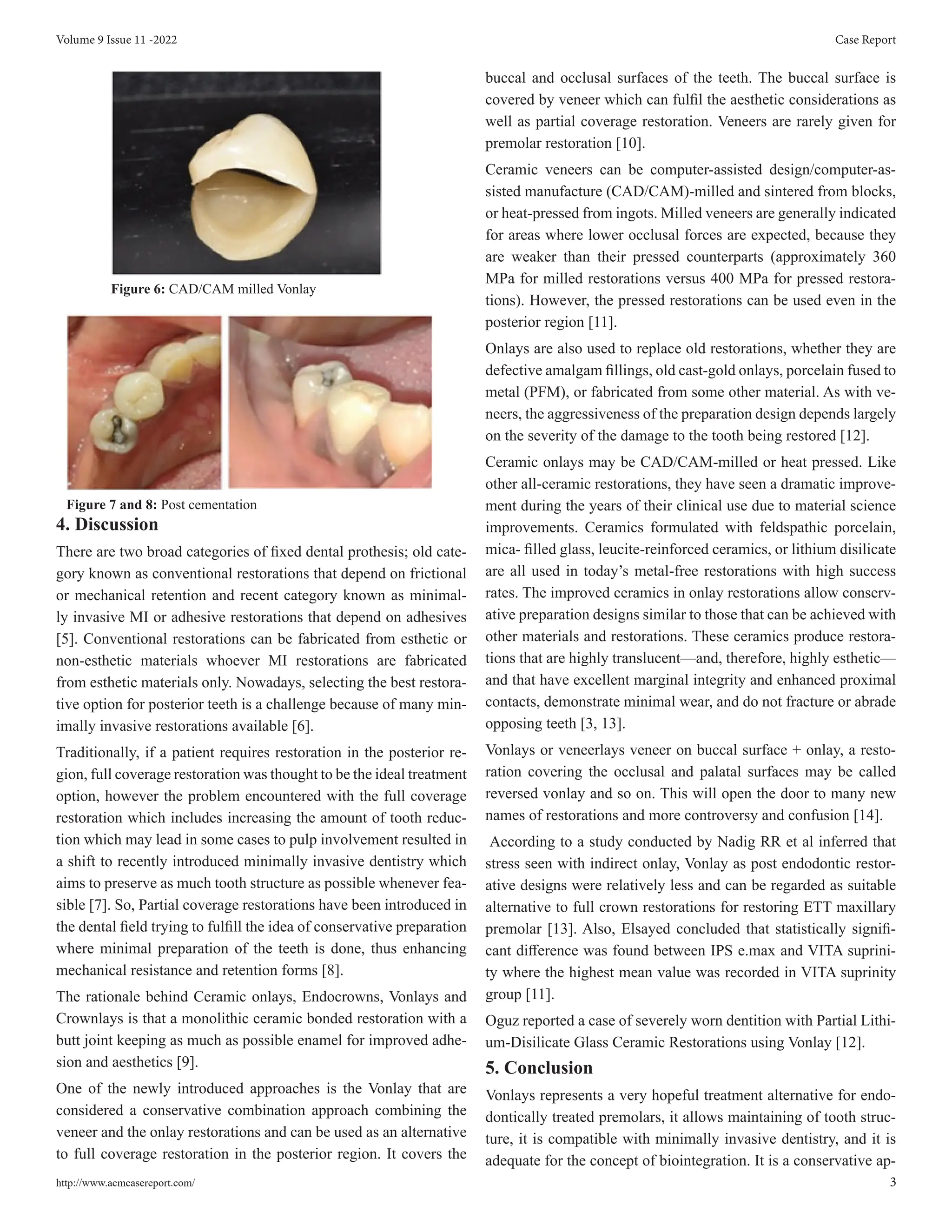Vonlay; A Paradigm Shift in Post Endodontic Restoration: A Case Report ...