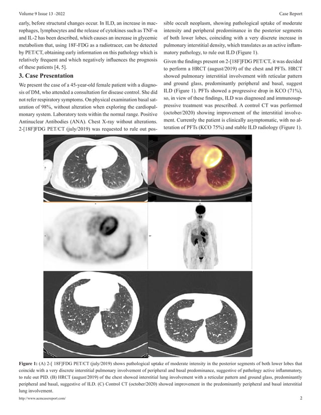 Early detection of interstitial lung disease in asymptomatic patients with 2-[ 18F]FDG PET/CT ...