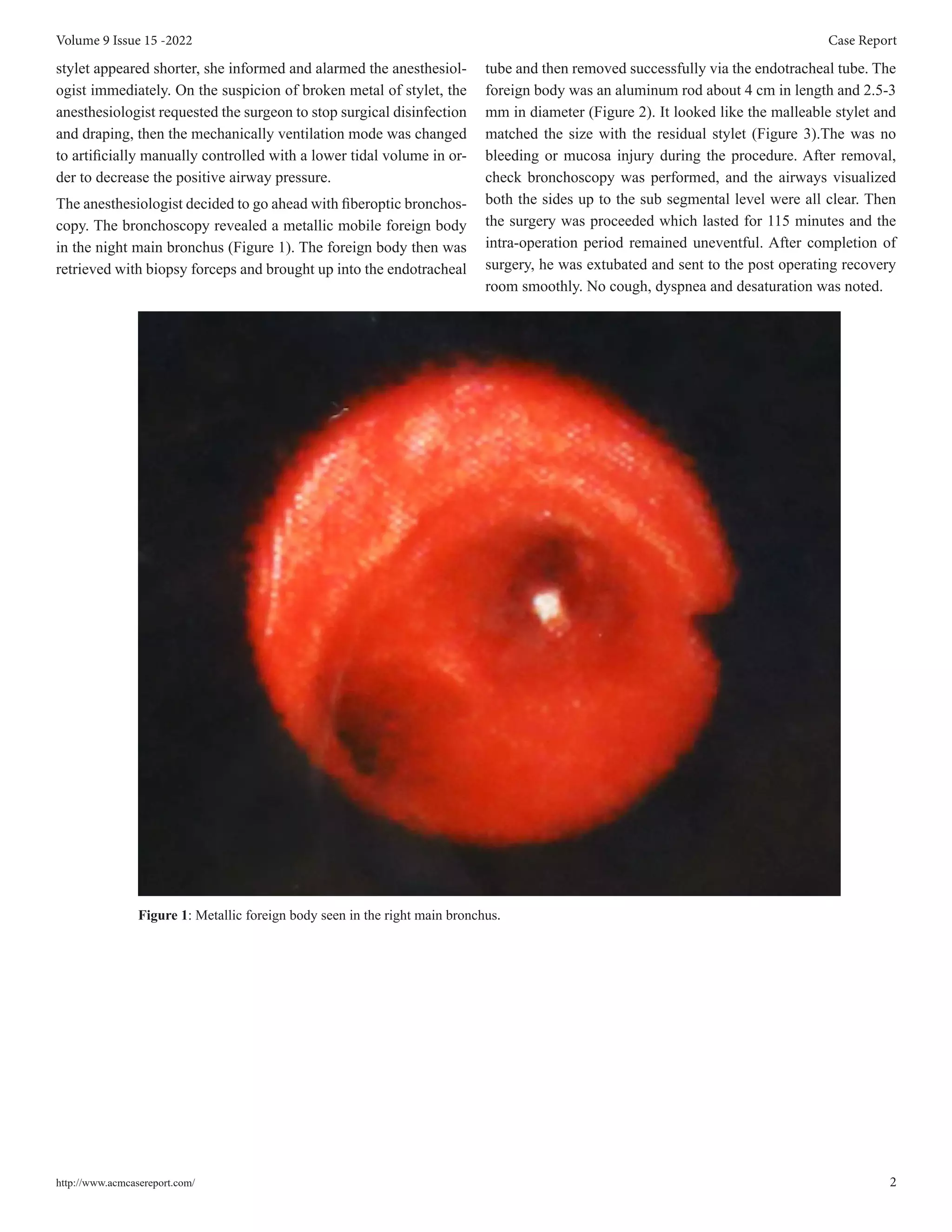 Successful management of a broken stylet retained in tracheobronchial ...