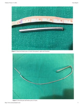 Successful management of a broken stylet retained in tracheobronchial ...