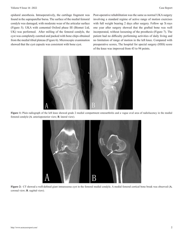 Medial compartment osteoarthritis with a large subchondral geode of ...
