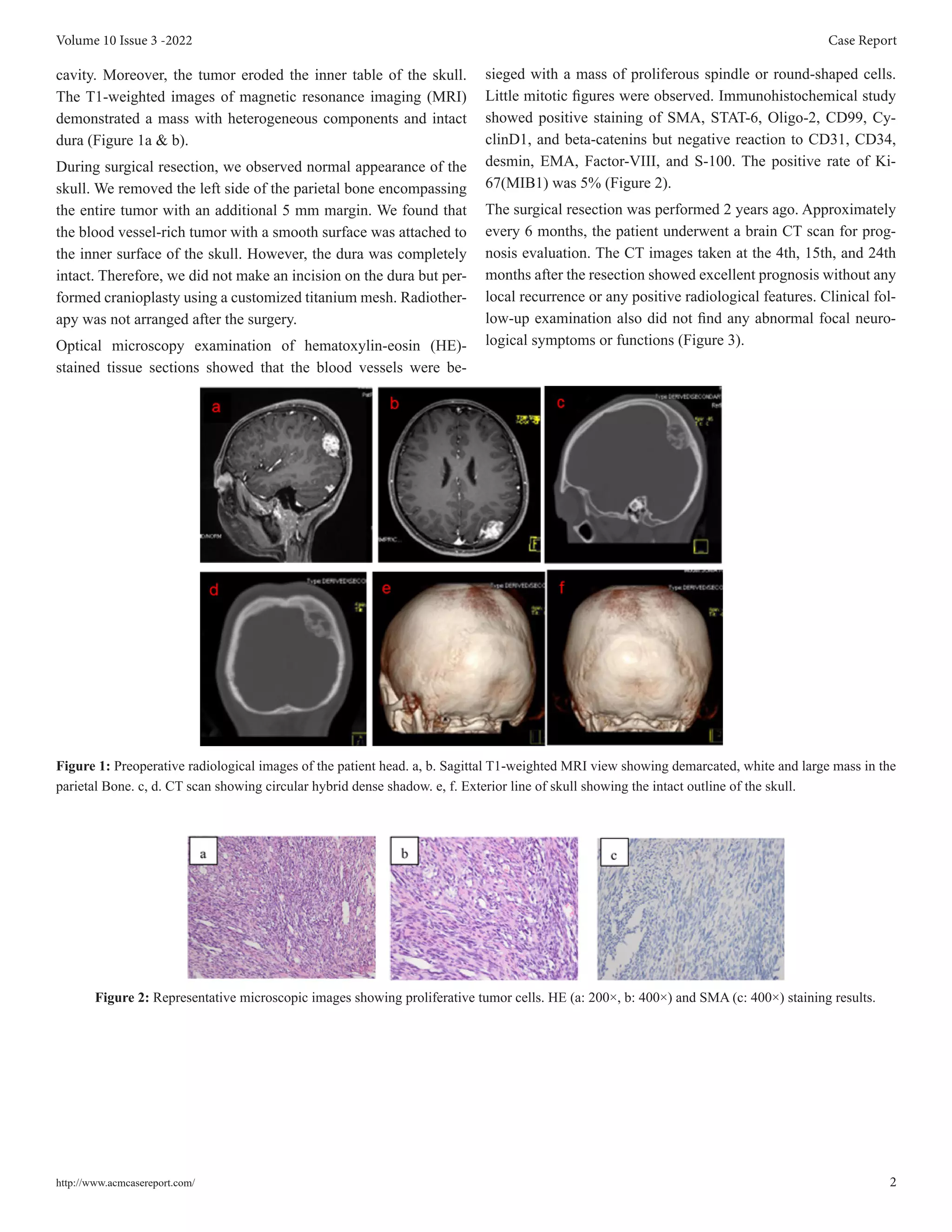Primary Hemangiopericytoma in Parietal Bone: Literature Review and Case ...