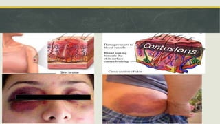 Abrasion and Contusion MedicoLegalAspects.pptx
