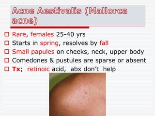 Acne Aestivalis
