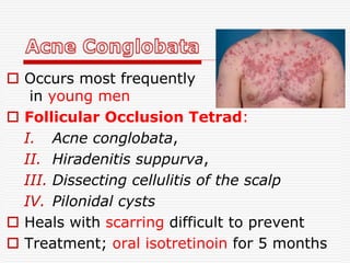 Acne Conglobata On Scalp