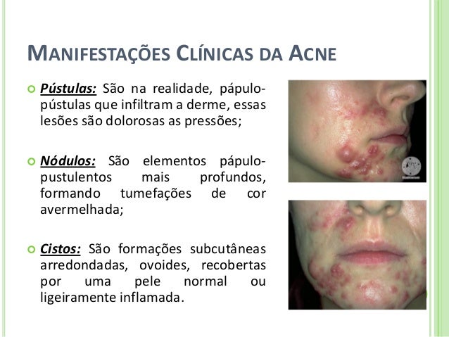 Acne Fisioterapia Dermatofuncional