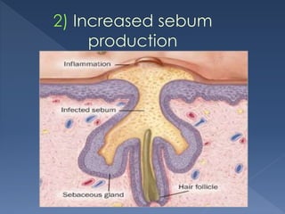 Acne | PPTX