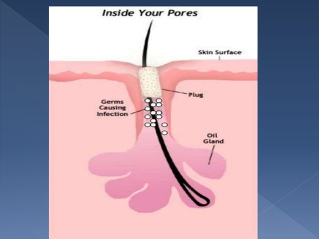 Acne | PPTX | Skin and Dermatology | Diseases and Conditions
