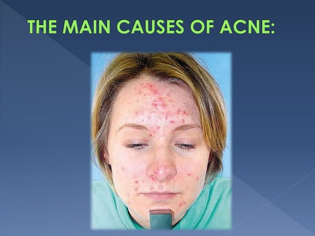 Acne | PPTX | Skin and Dermatology | Diseases and Conditions