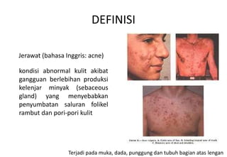 Acne? | PPTX