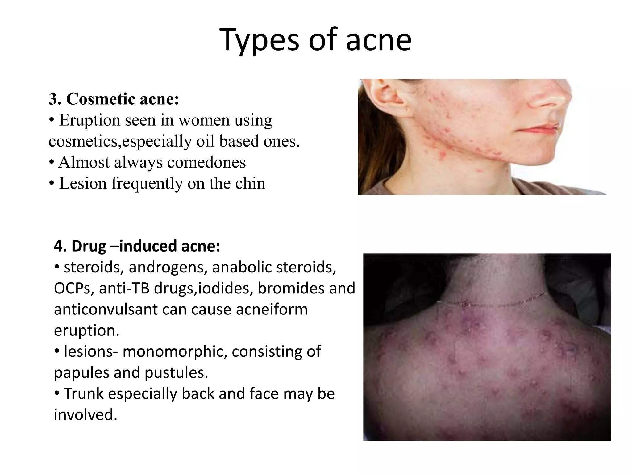 Acne | PPTX