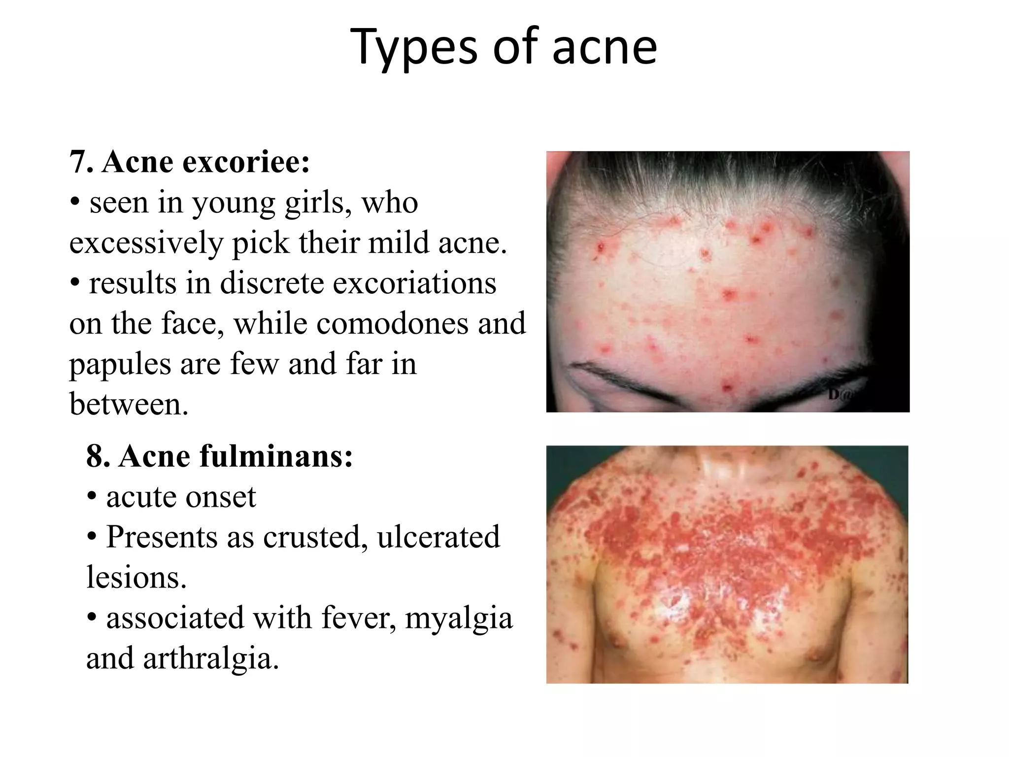 Acne | PPTX