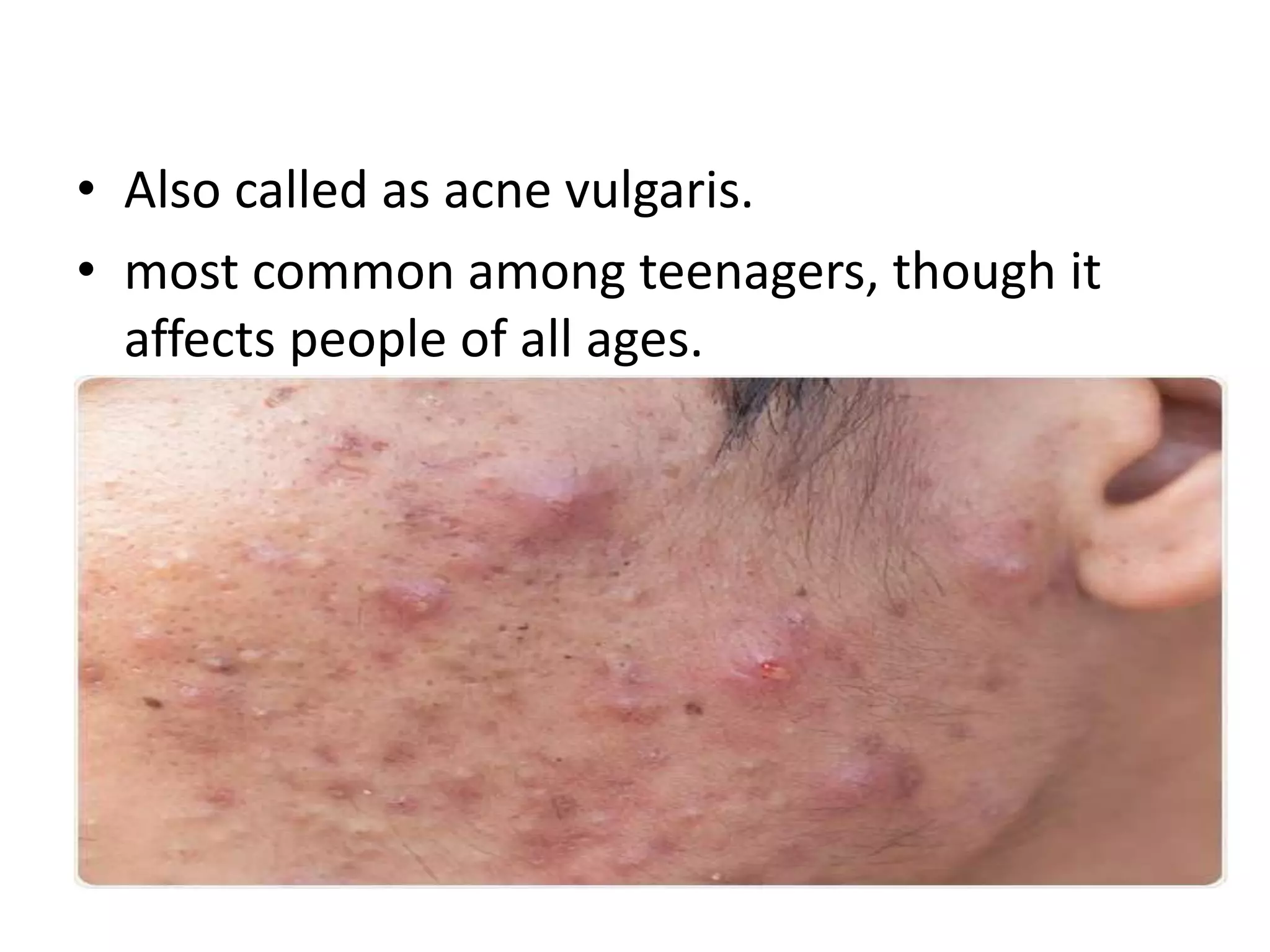Acne | PPTX