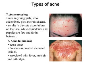 Acne | PPTX