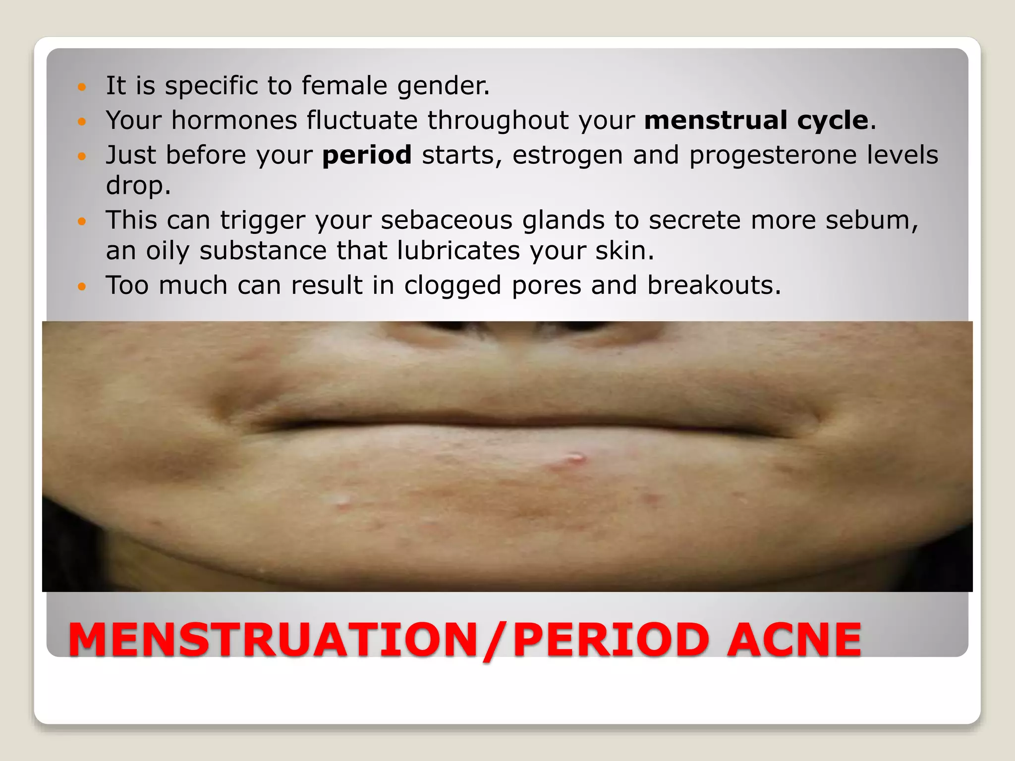Acne Vulgaris | PPTX