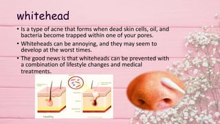 Acne | PPTX