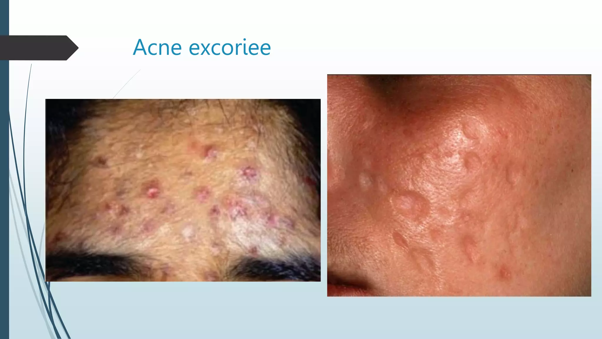 Acne.pptx