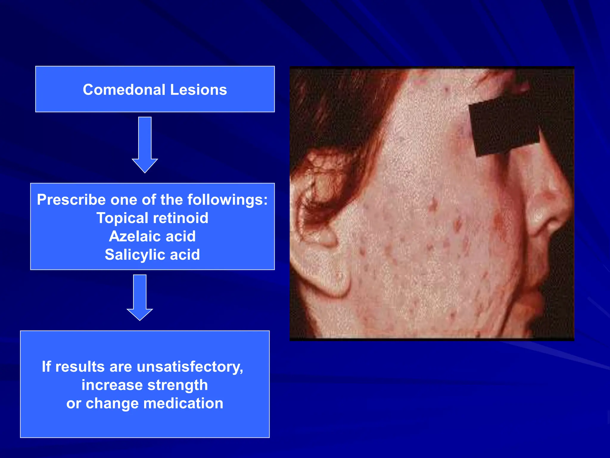 acne.ppt pharmacotherapy for treating acne | PPT