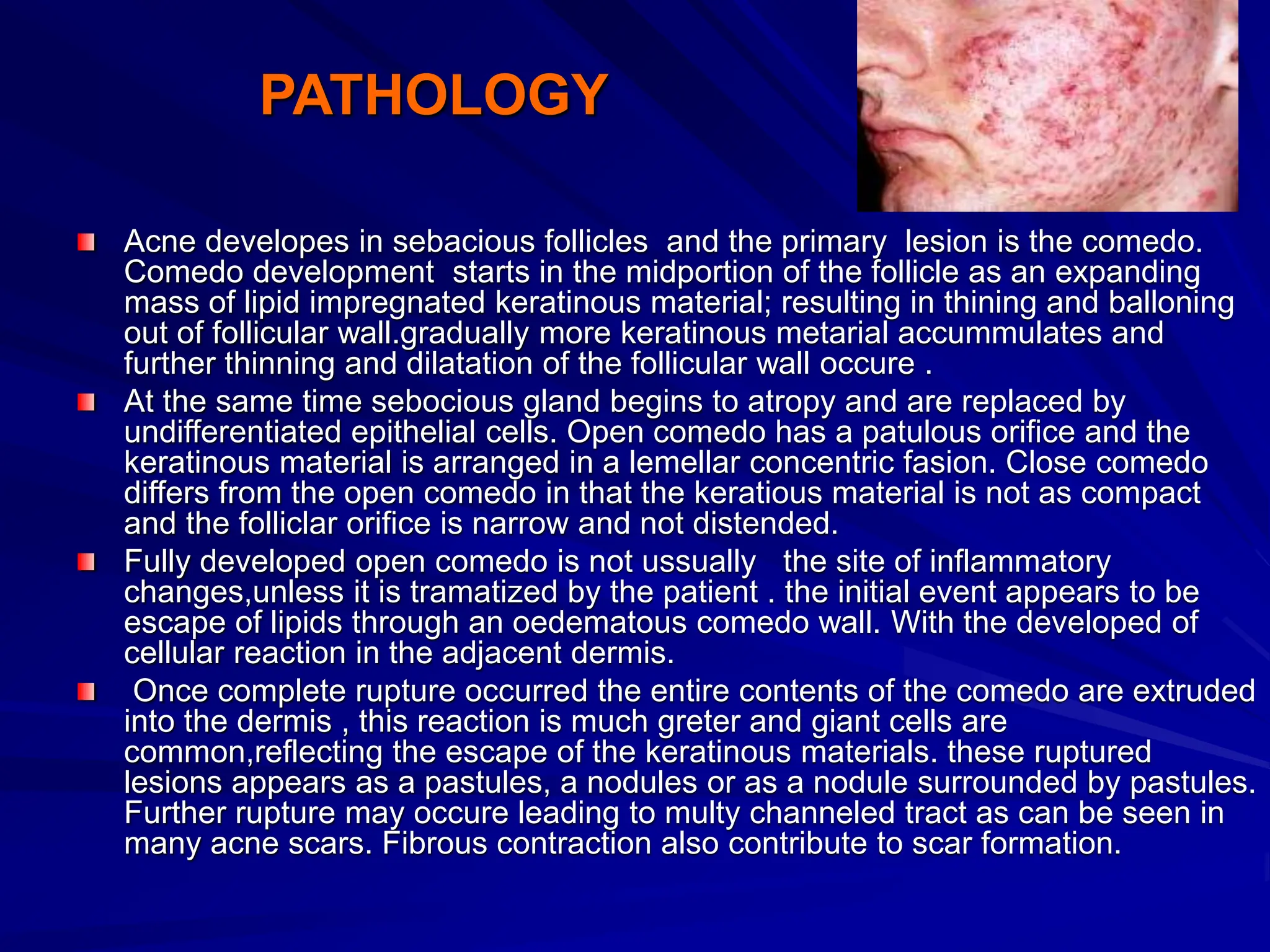 acne.ppt pharmacotherapy for treating acne | PPT